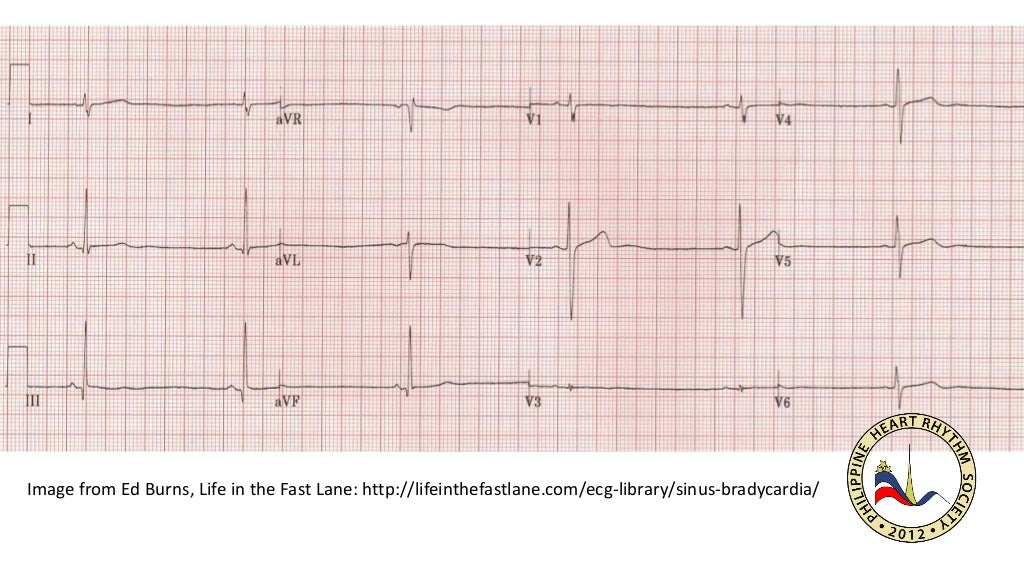 Bradyarrhythmia Lecture PHRS 2015