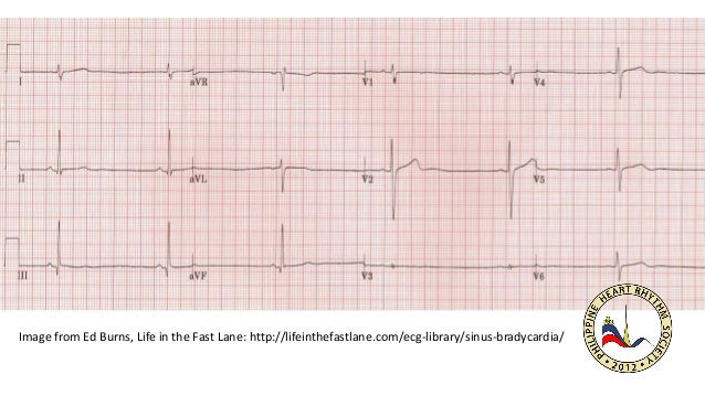 Bradyarrhythmia Lecture PHRS 2015