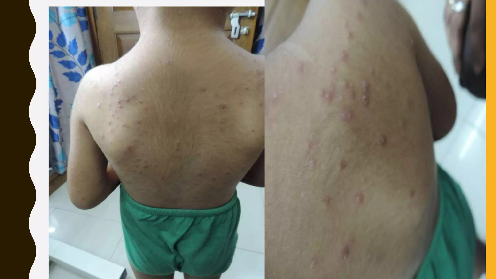 pustular granuloma annulare.pptx