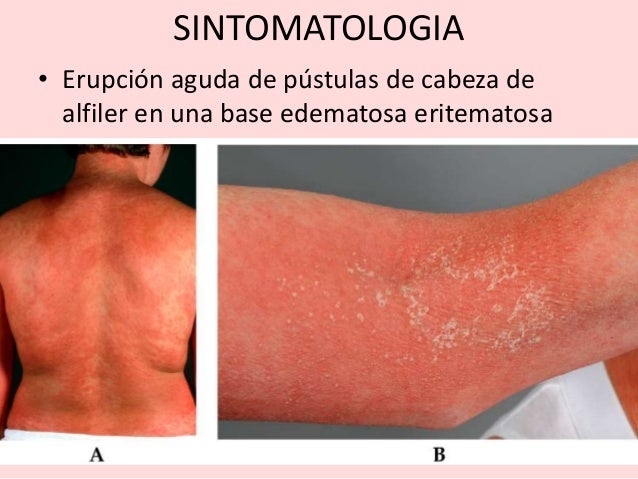 Pustulosis exantemica aguda generalizada (agep)
