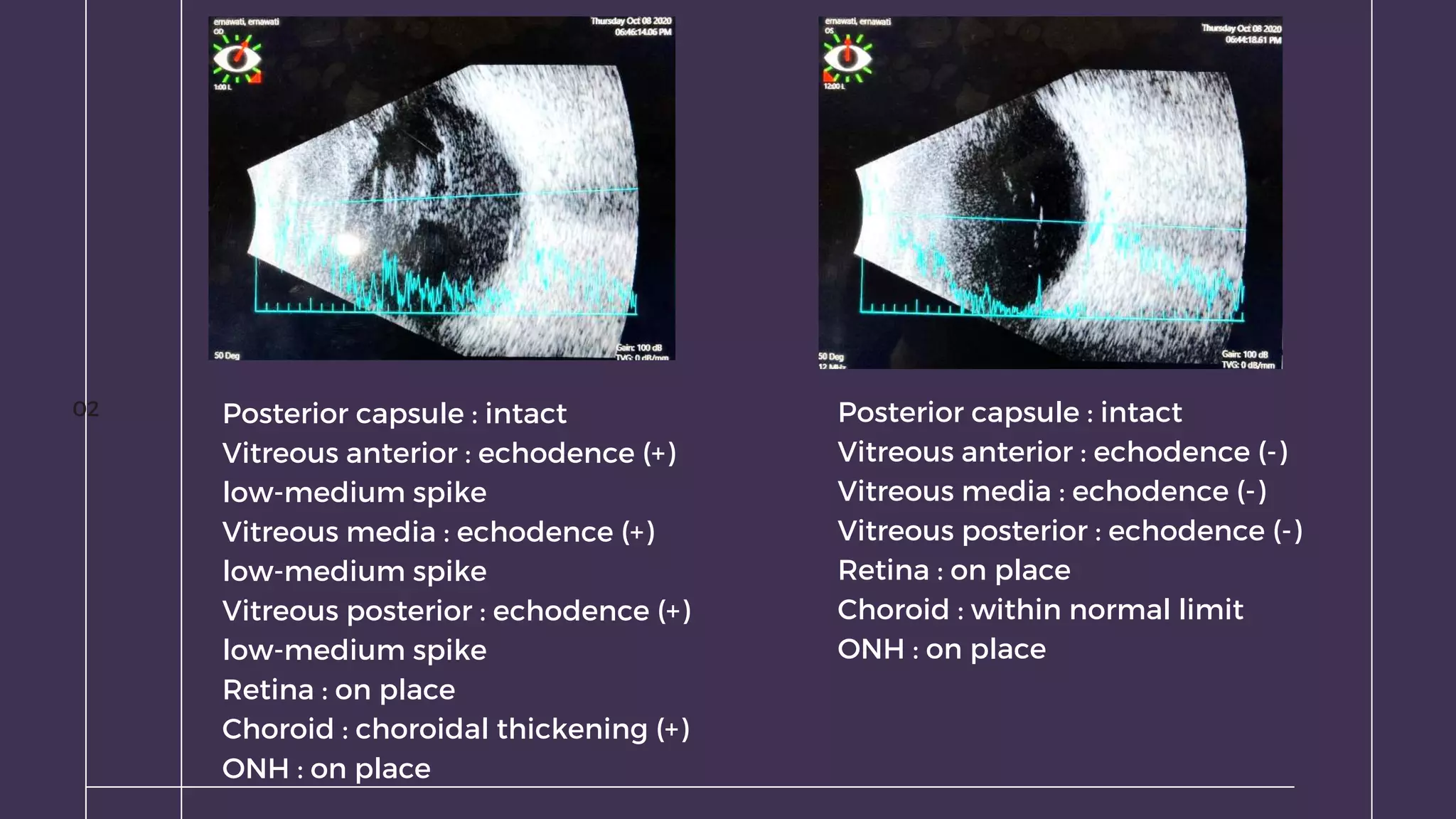 Acute Post Operative Endophthalmitis (Pseudomonas aeruginosa MDR) | PDF