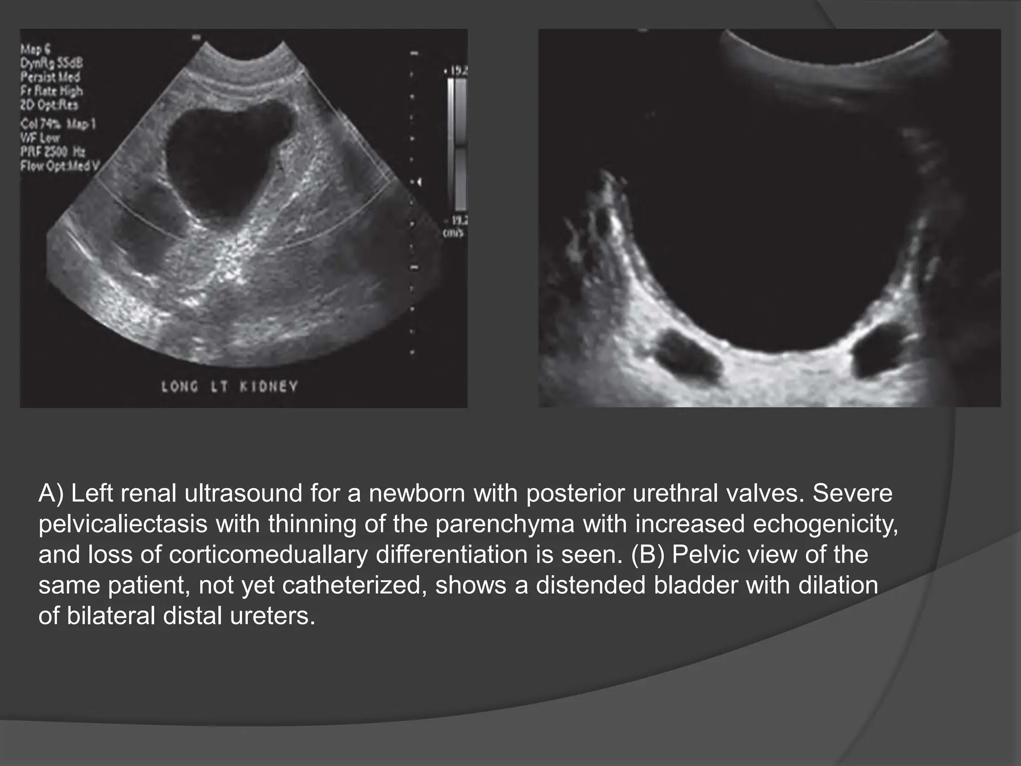 Posterior urethral valve | PPTX