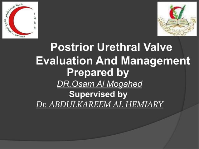 Posterior urethral valve | PPTX