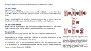 Posterior urethral valve. DR SACHIN K.pptx
