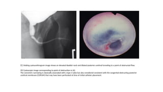 Posterior urethral valve managment DR SACHIN | PPTX