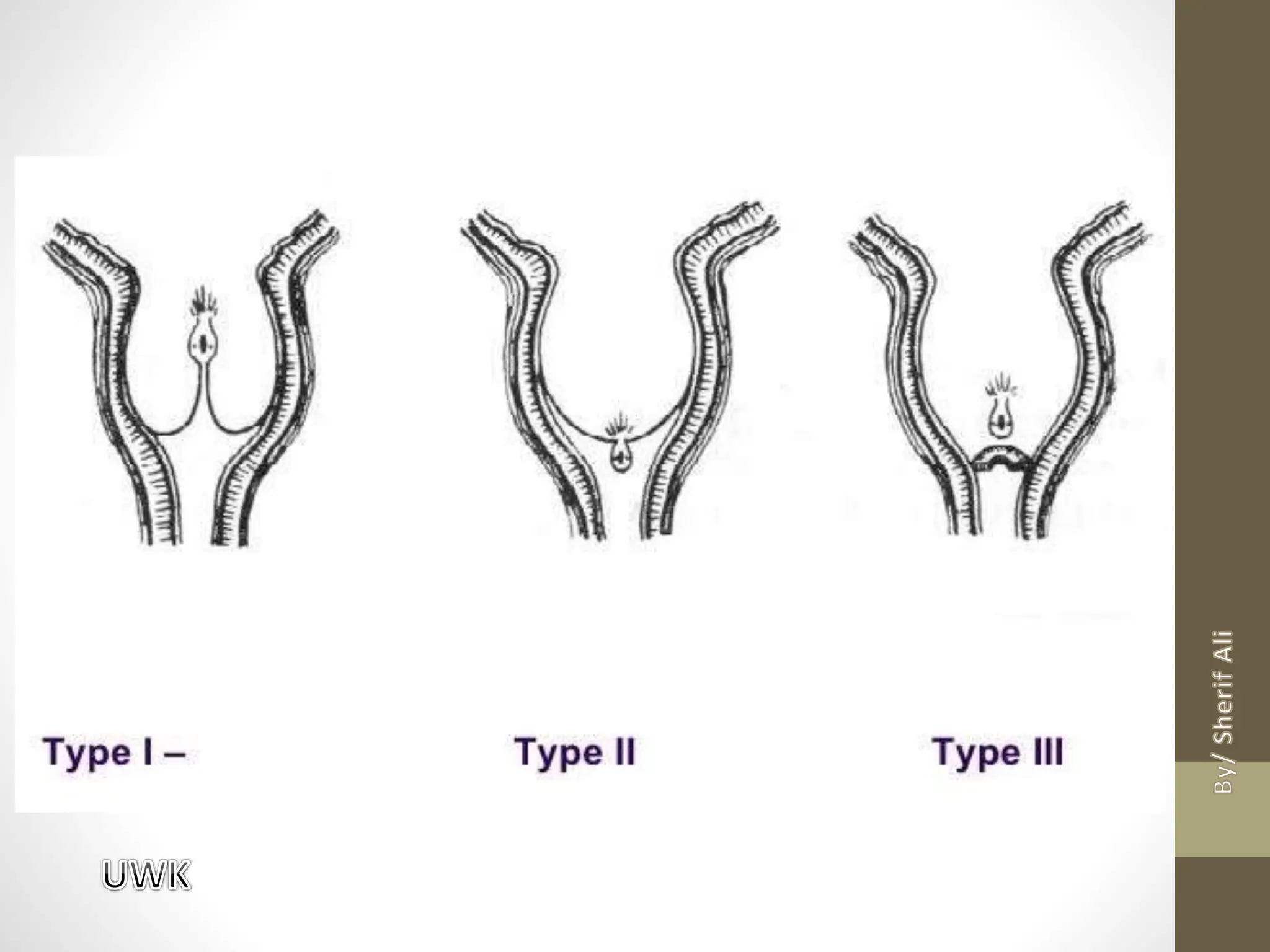 PUV presentation urology in sohag university.pptx | Free Download