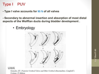 PUV presentation urology in sohag university.pptx