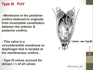 PUV presentation urology in sohag university.pptx