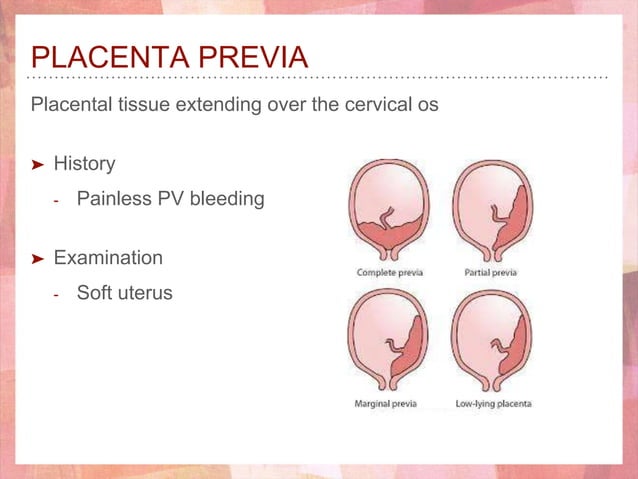 PV Bleeding | PPTX | Pregnancy | Reproductive Health