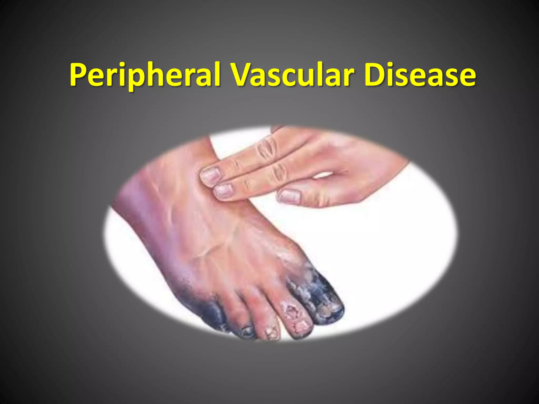 Peripheral Vascular Disease Ppt