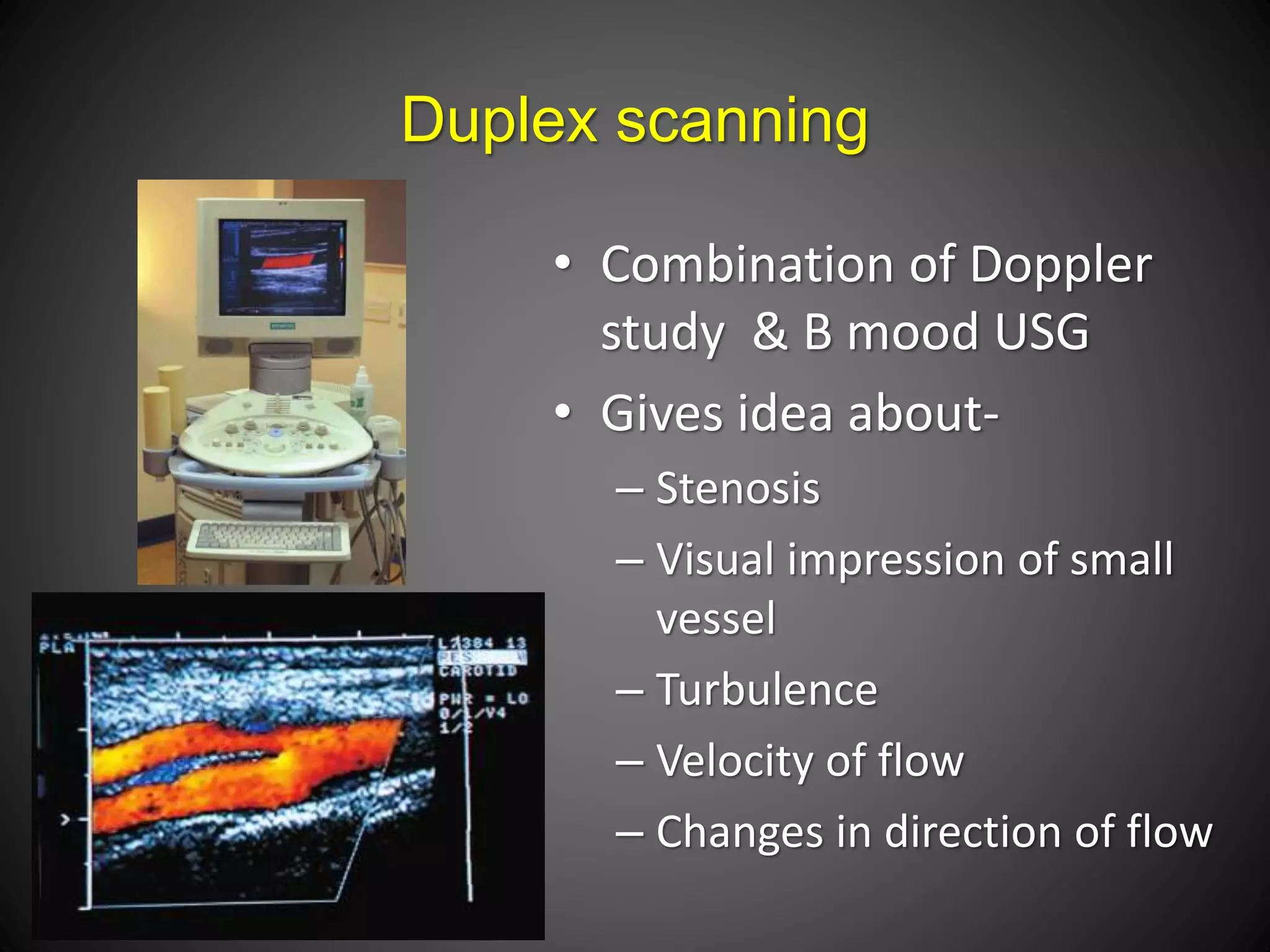 peripheral vascular disease | PPTX