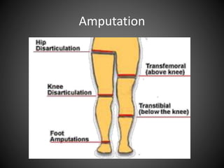 peripheral vascular disease | PPTX