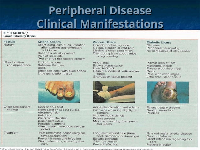 PVD peripheral vascular disease management.ppt