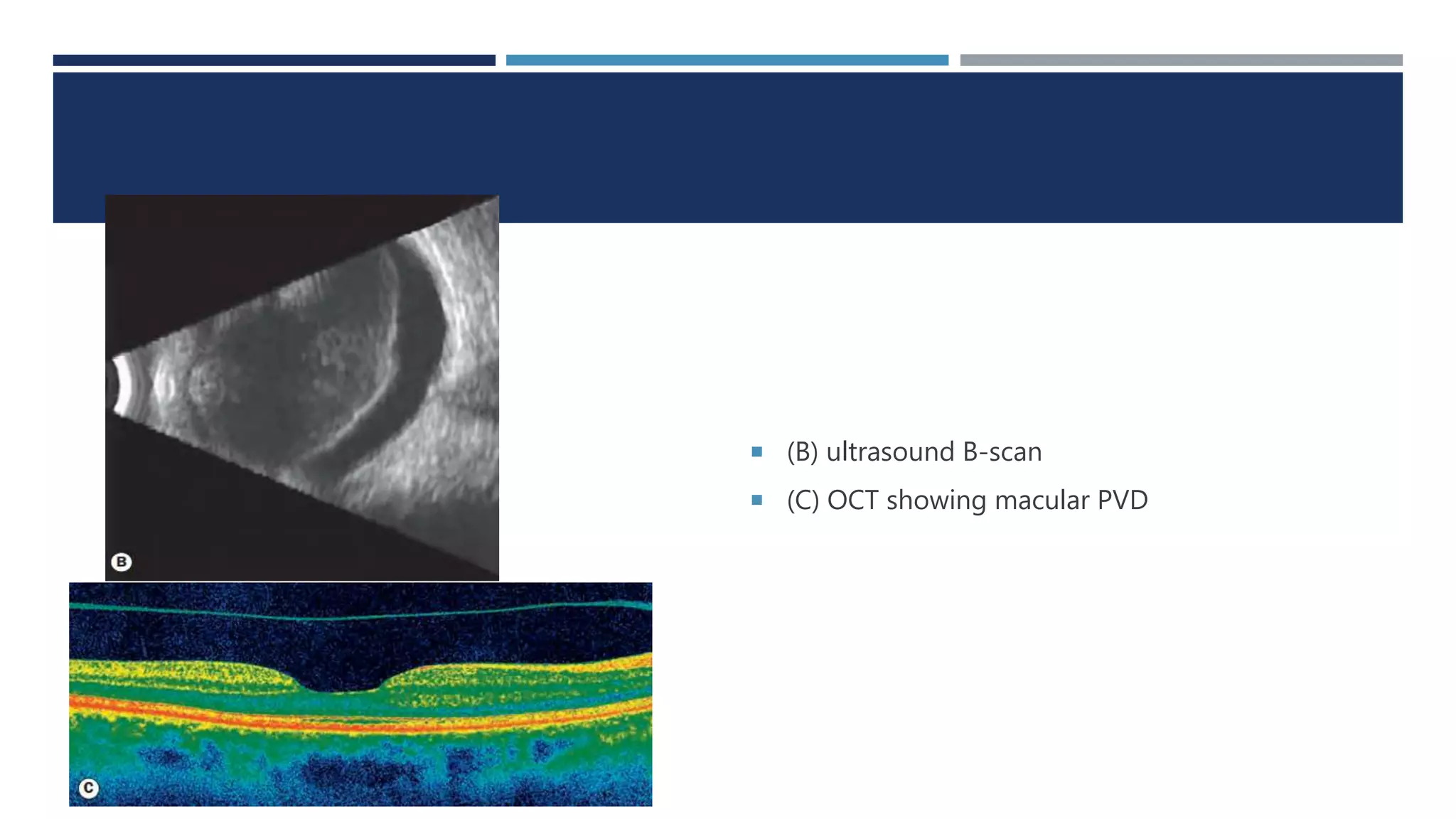 Posterior vitreous detachment - KANSKI | PPTX