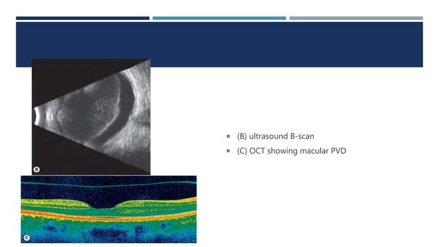 Posterior vitreous detachment - KANSKI | PPTX | Eye and Vision ...