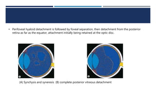 Posterior vitreous detachment - KANSKI | PPTX