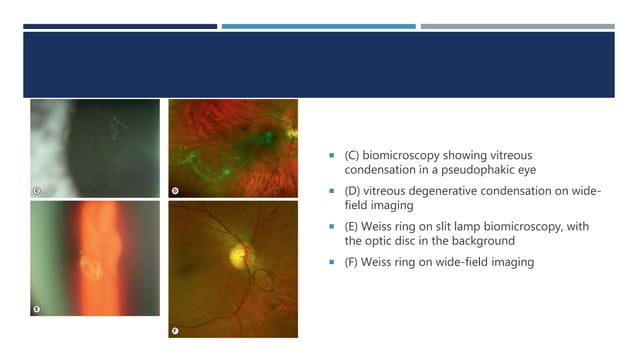Posterior vitreous detachment - KANSKI | PPTX | Eye and Vision ...