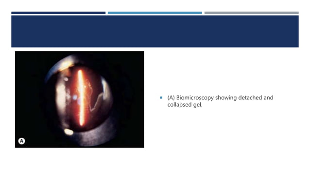 Posterior vitreous detachment - KANSKI | PPTX | Eye and Vision ...