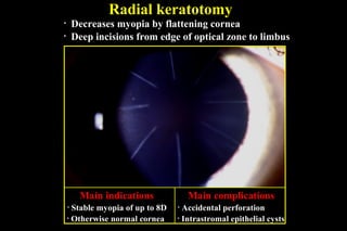 20 corneal surgery | PPT