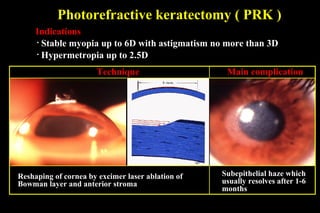 20 corneal surgery | PPT