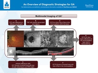 Improving the Patient Experience in Geographic Atrophy: Are You Putting ...