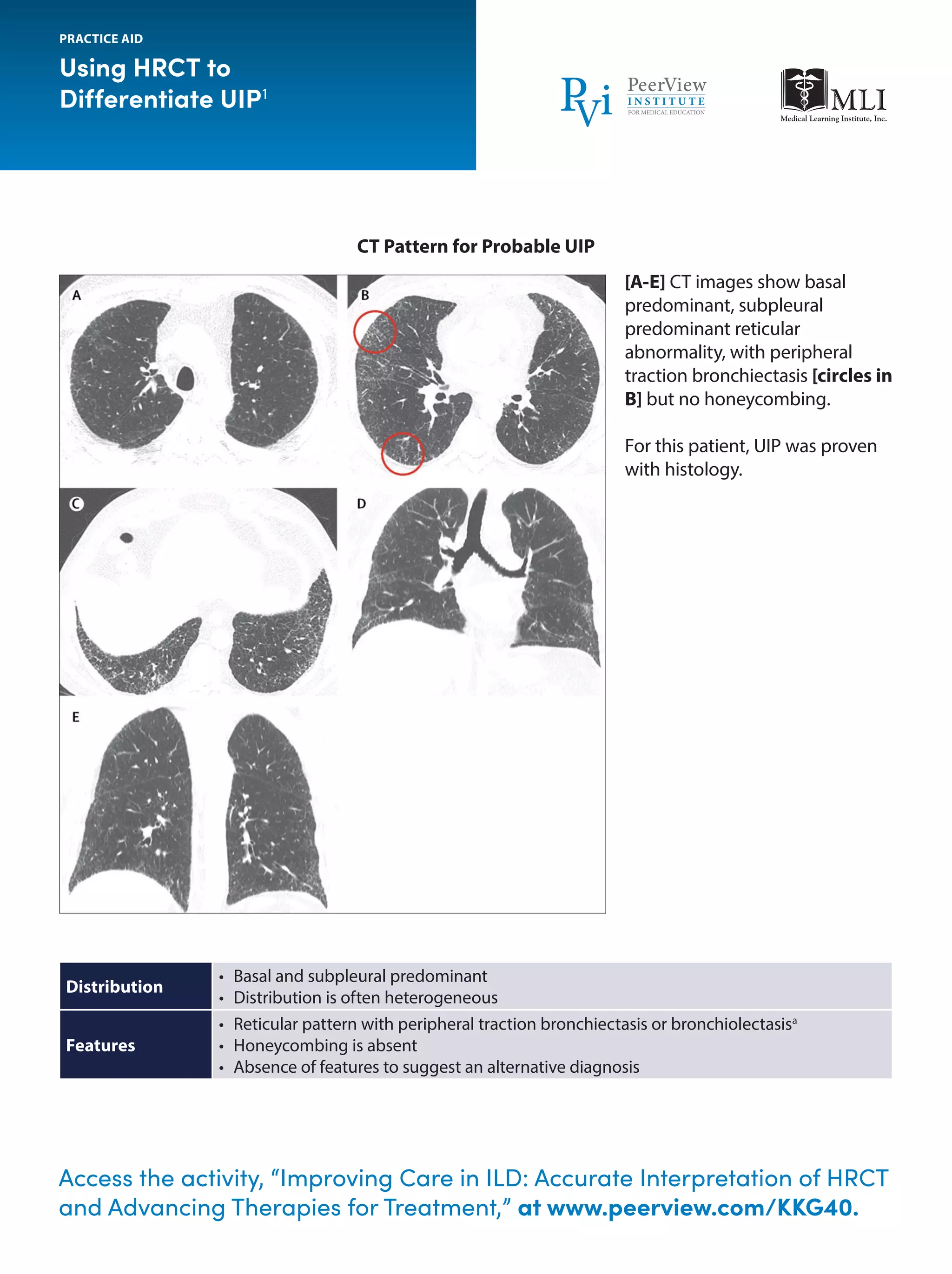 Improving Care in ILD: Accurate Interpretation of HRCT and Advancing ...