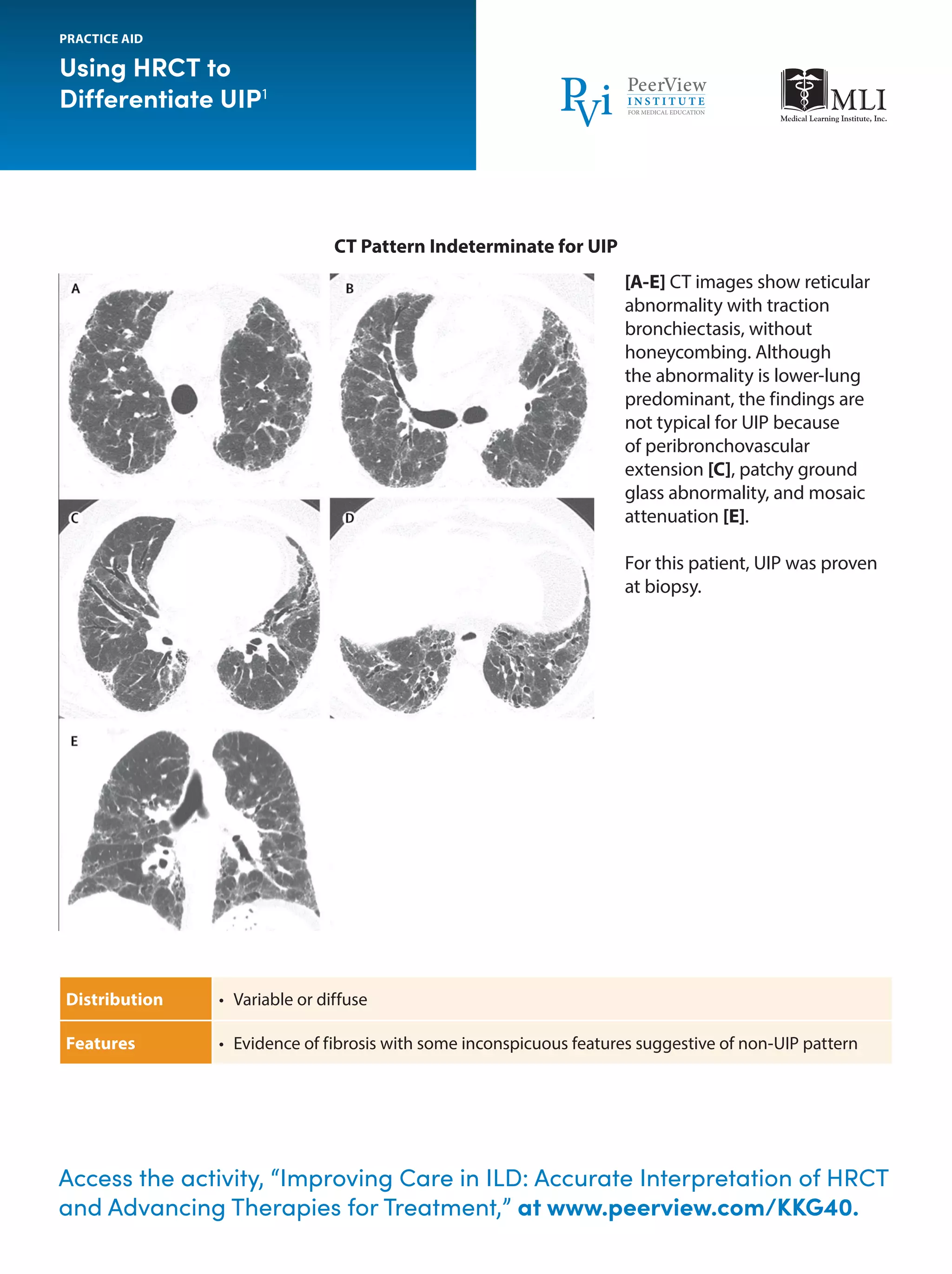 Improving Care in ILD: Accurate Interpretation of HRCT and Advancing ...