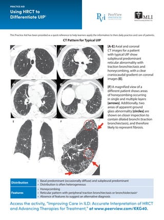 Improving Care in ILD: Accurate Interpretation of HRCT and Advancing ...