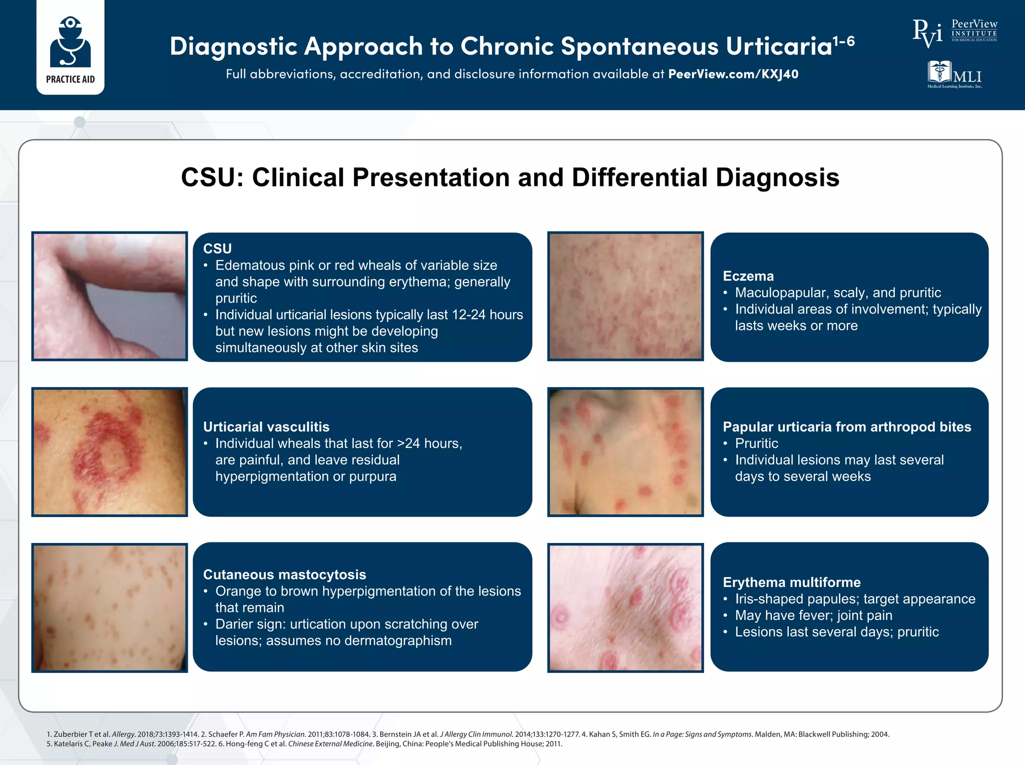 Chronic Spontaneous Urticaria From Diagnosis to Treatment: Unique ...