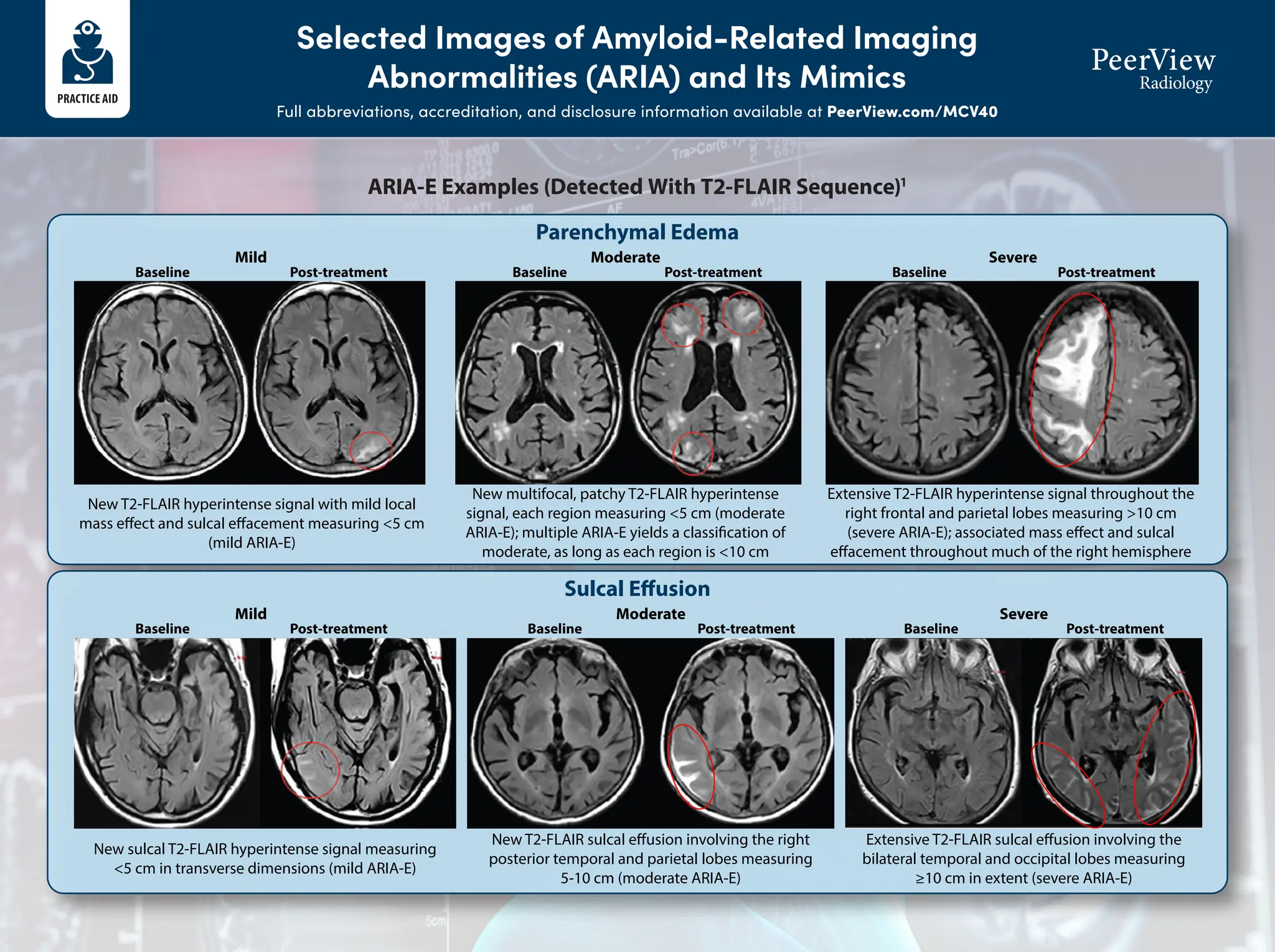 Improving the Recognition and Management of Amyloid-Related Imaging Abnormalities (ARIA) in ...