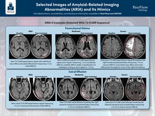 Improving the Recognition and Management of Amyloid-Related Imaging Abnormalities (ARIA) in ...
