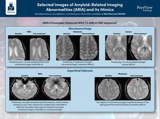 Improving the Recognition and Management of Amyloid-Related Imaging ...