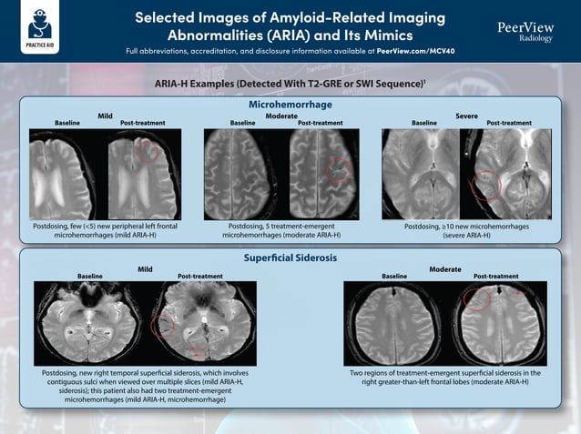 Improving the Recognition and Management of Amyloid-Related Imaging ...