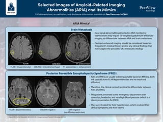 Improving the Recognition and Management of Amyloid-Related Imaging ...