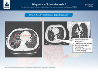 Improving Time to Diagnosis of Non-Cystic Fibrosis Bronchiectasis: The ...