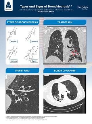 Improving Time to Diagnosis of Non-Cystic Fibrosis Bronchiectasis: The ...