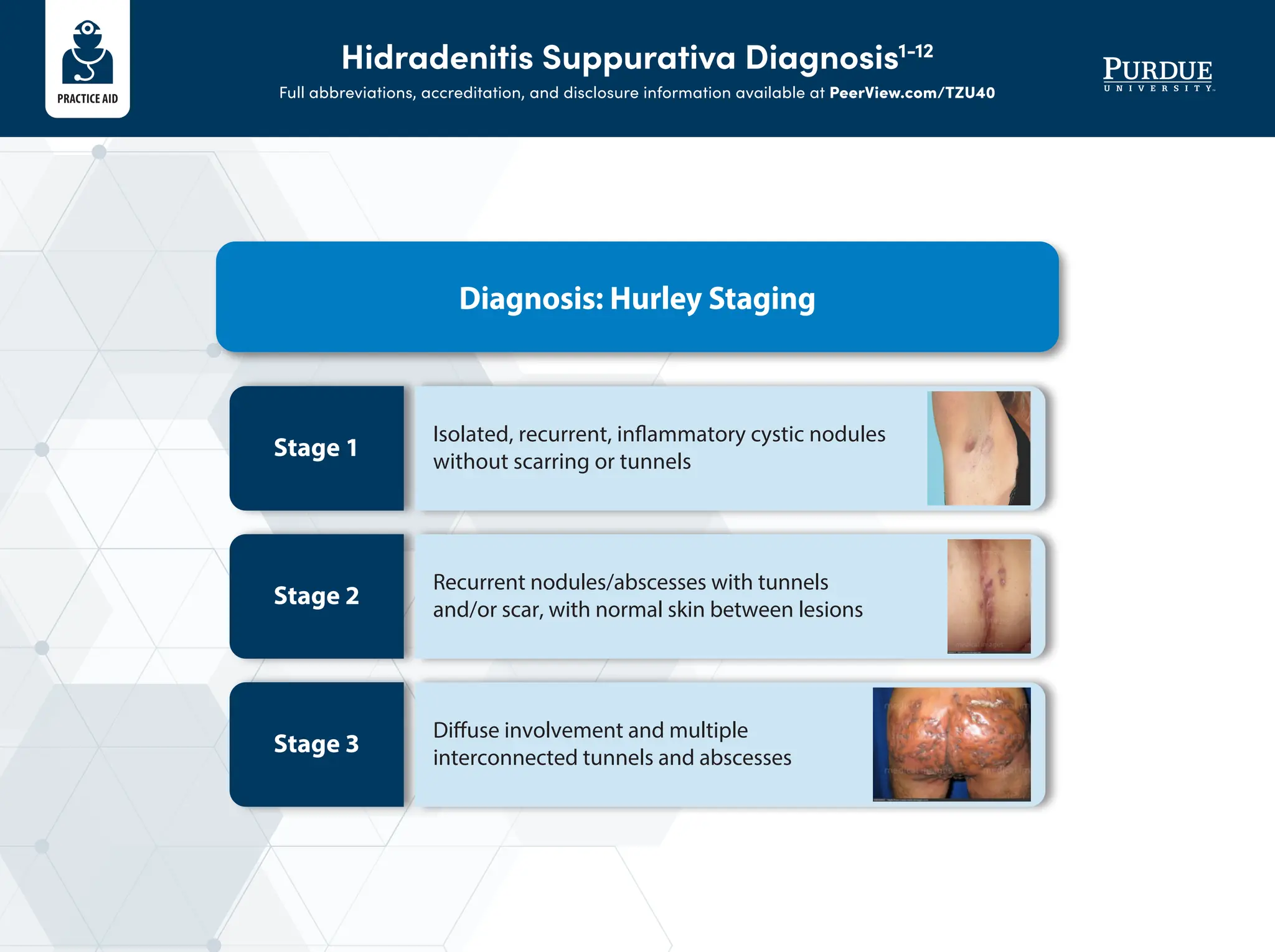 don-t-miss-hidradenitis-suppurativa-providing-timely-diagnosis-and