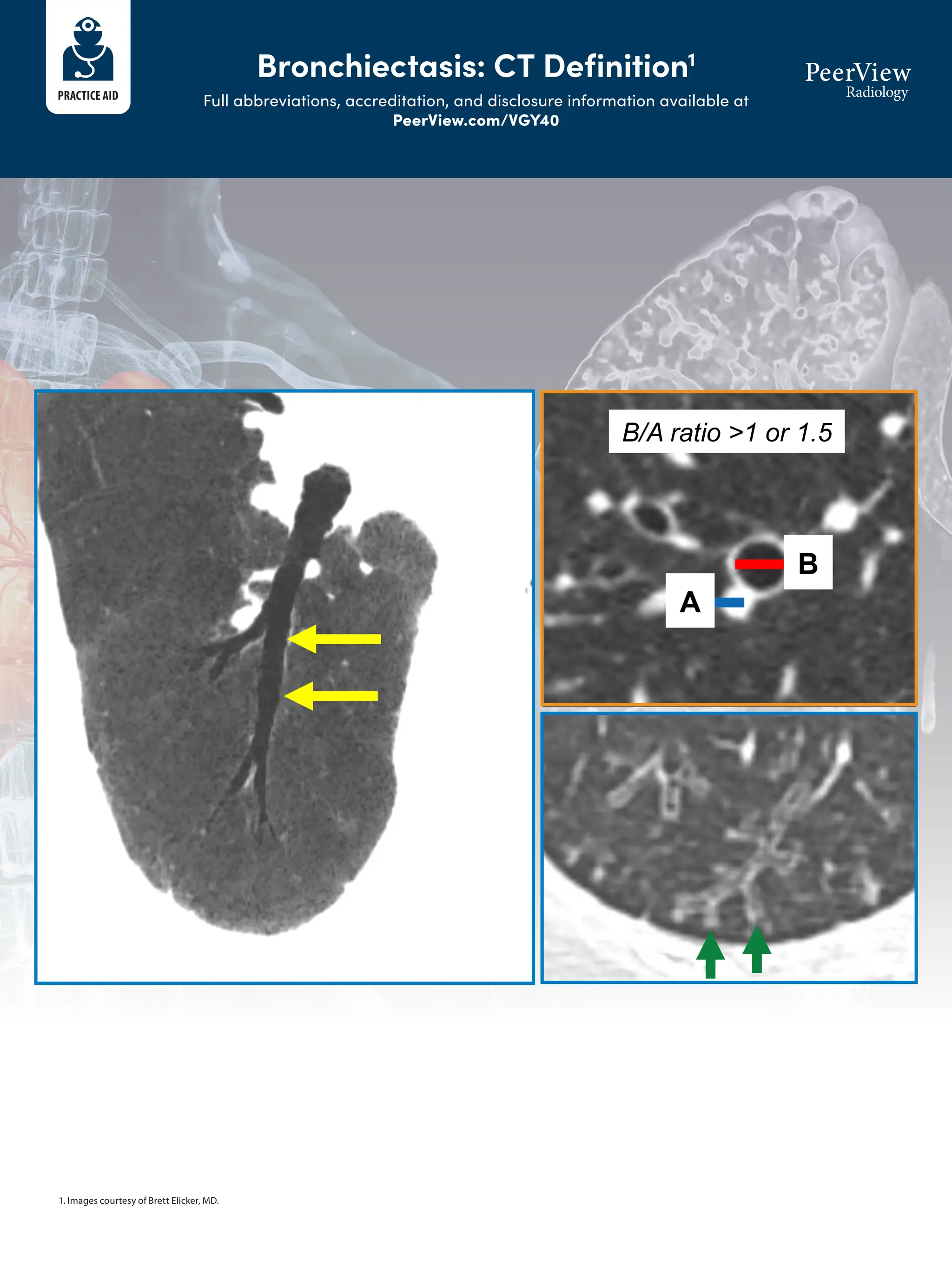Bridging the Gap to Improved Outcomes in Non-Cystic Fibrosis ...