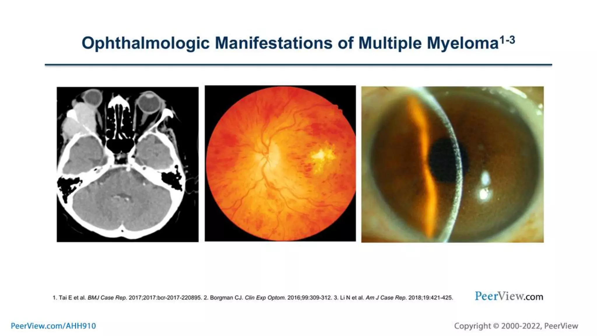 The Eye-Deal Connection in Multiple Myeloma: Establishing Ophthalmology ...