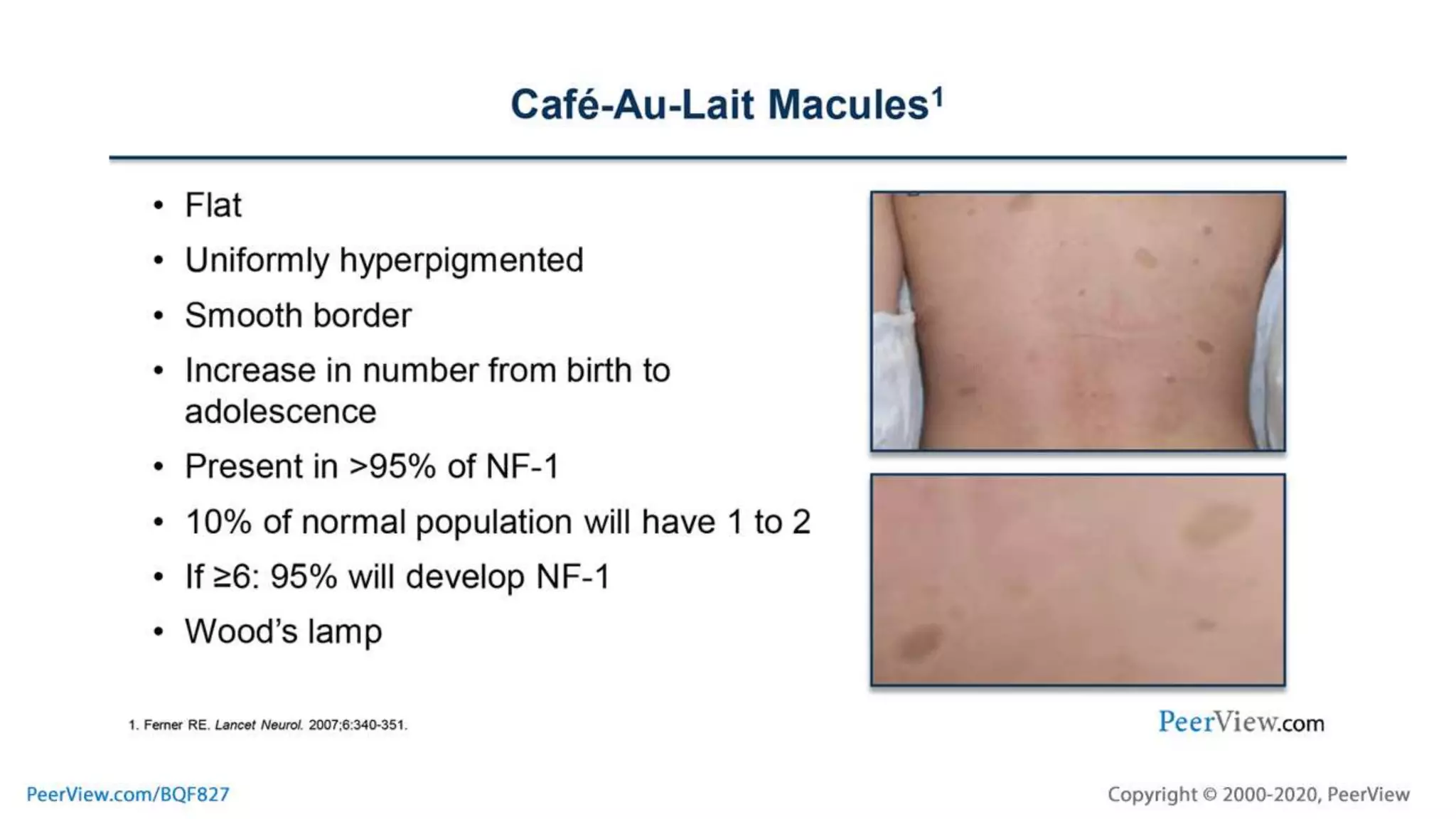 Targeting the RAS/MAPK Pathway in Neurofibromatosis Type 1, Plexiform ...