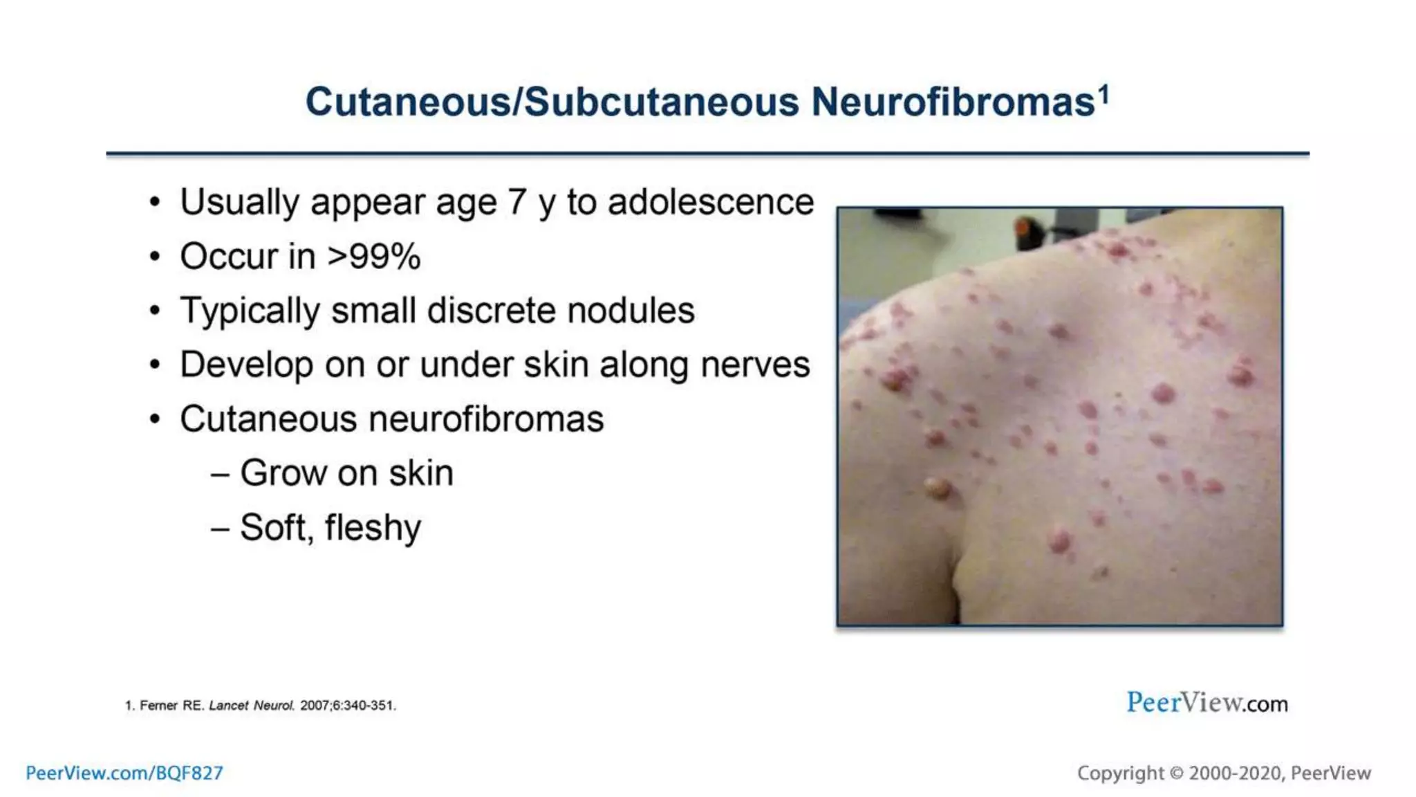 Targeting the RAS/MAPK Pathway in Neurofibromatosis Type 1, Plexiform ...