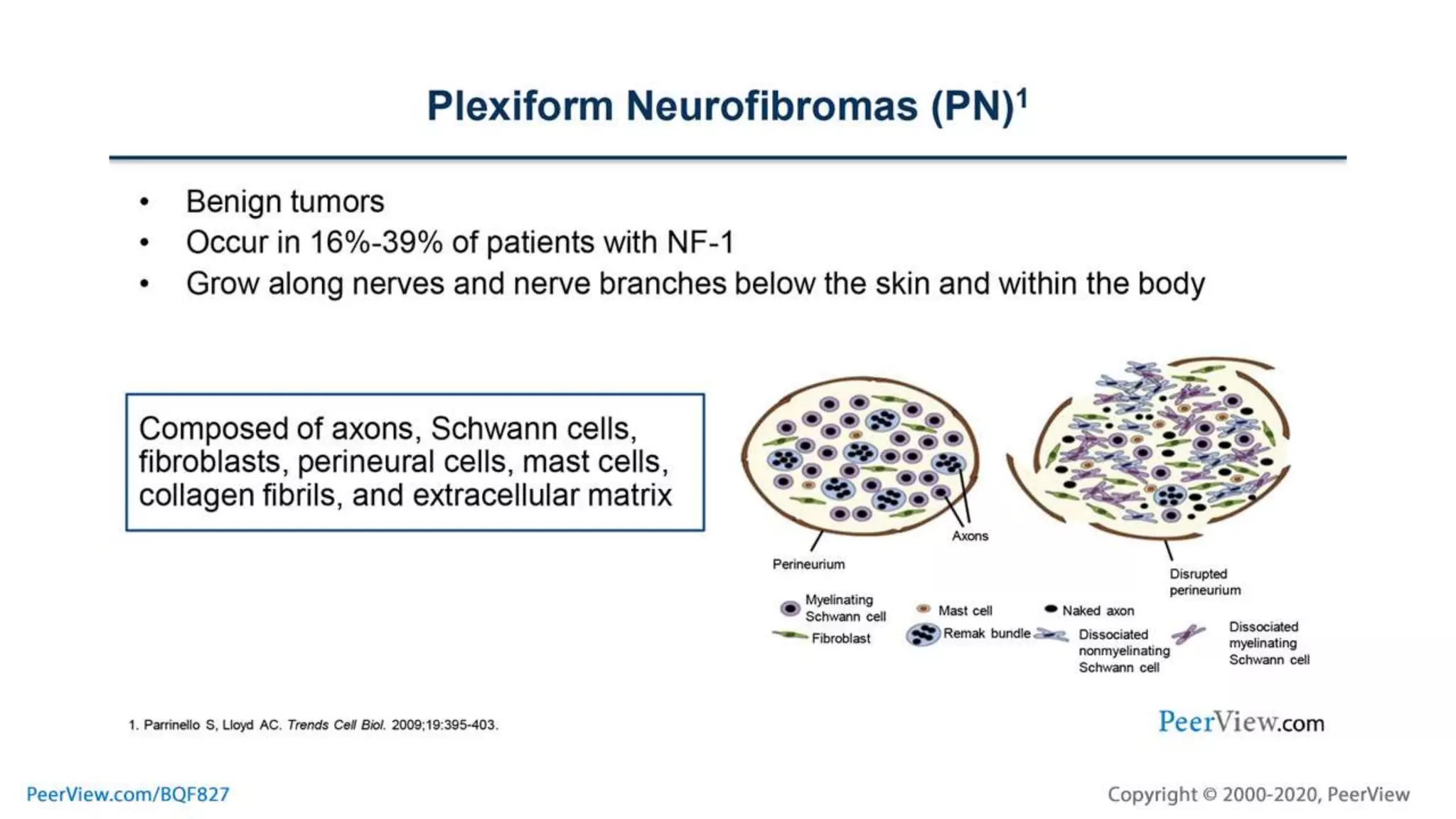 Targeting the RAS/MAPK Pathway in Neurofibromatosis Type 1, Plexiform ...