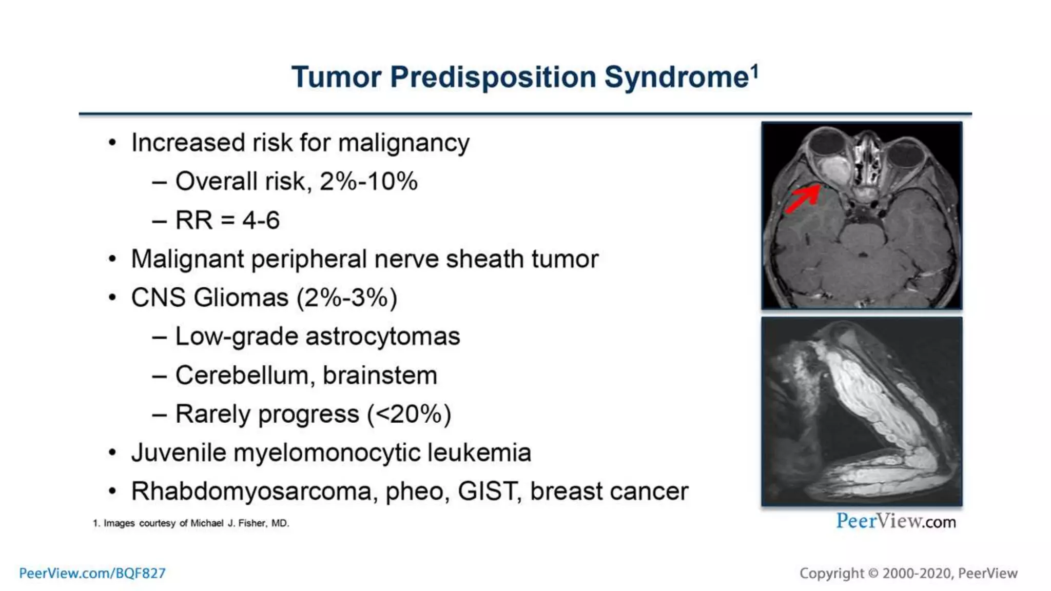 Targeting the RAS/MAPK Pathway in Neurofibromatosis Type 1, Plexiform ...