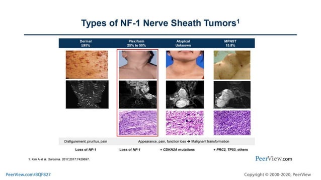 Targeting the RAS/MAPK Pathway in Neurofibromatosis Type 1, Plexiform ...