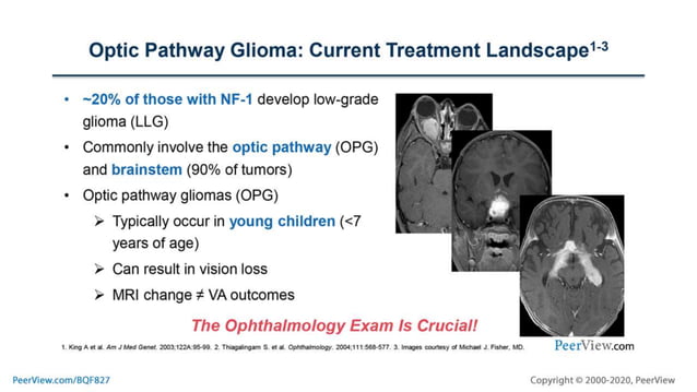 Targeting the RAS/MAPK Pathway in Neurofibromatosis Type 1, Plexiform ...