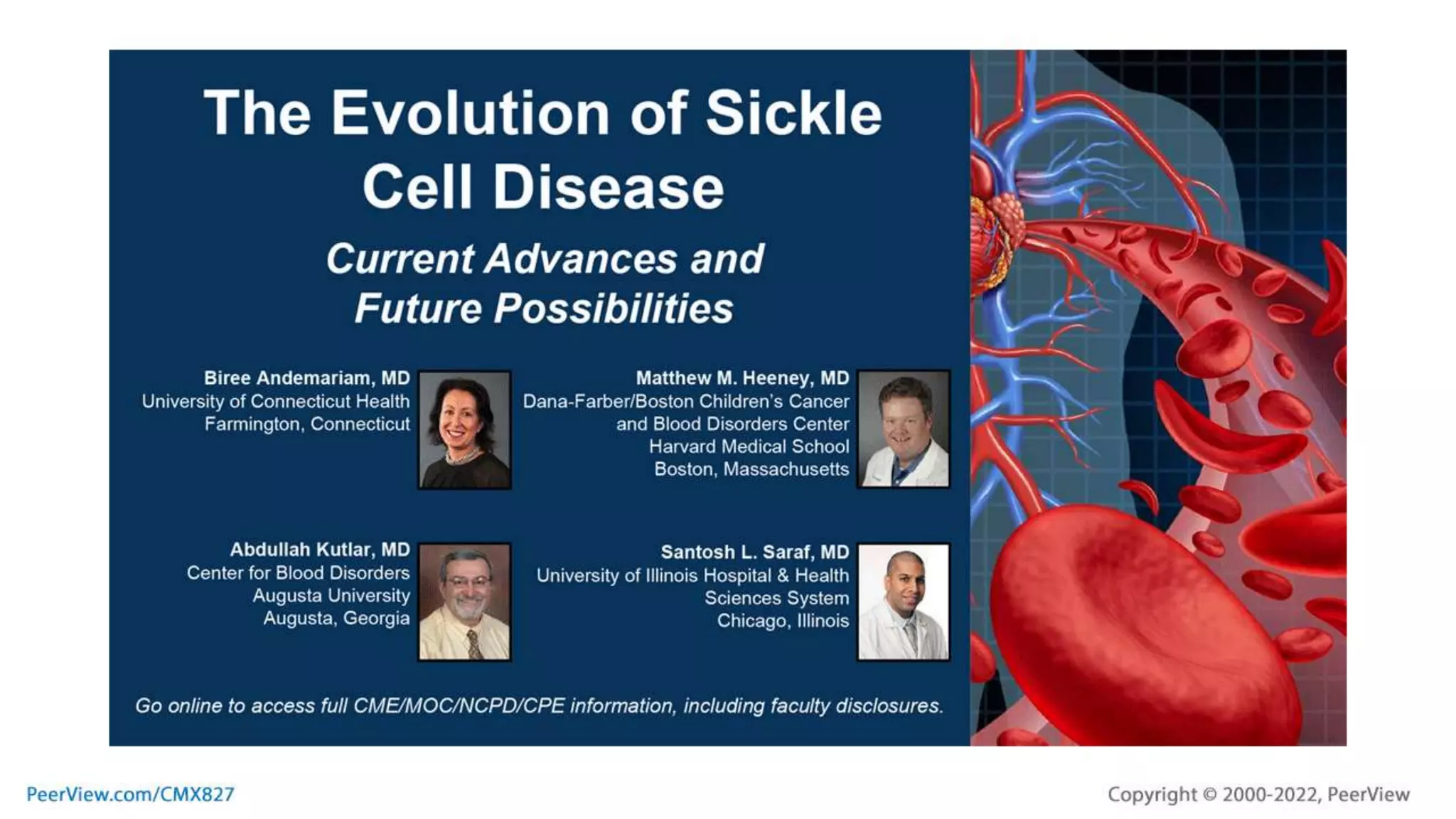The Evolution of Sickle Cell Disease: Current Advances and Future ...