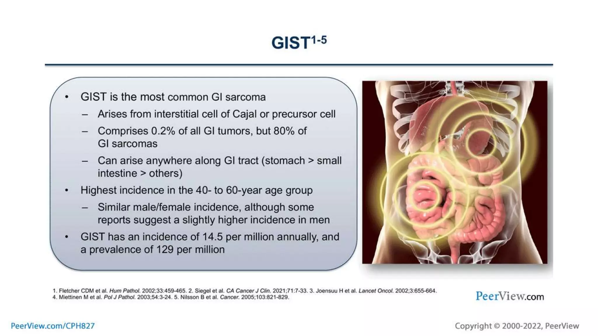Optimally Sequencing Modern TKIs in GIST: Expert Perspectives From an Interprofessional Sarcoma ...