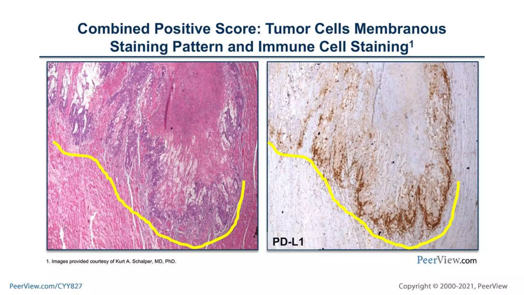 Revisiting PD-L1 as an Immunotherapy Biomarker Across the Cancer ...