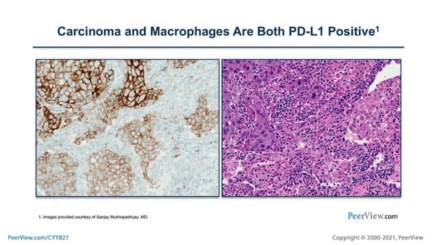 Revisiting PD-L1 as an Immunotherapy Biomarker Across the Cancer ...