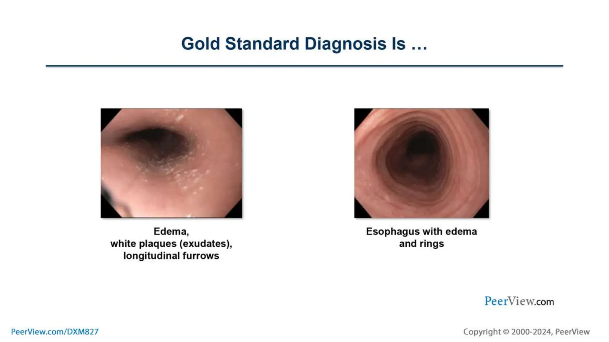 Targeting a Brighter Future for Pediatric Patients With Eosinophilic ...
